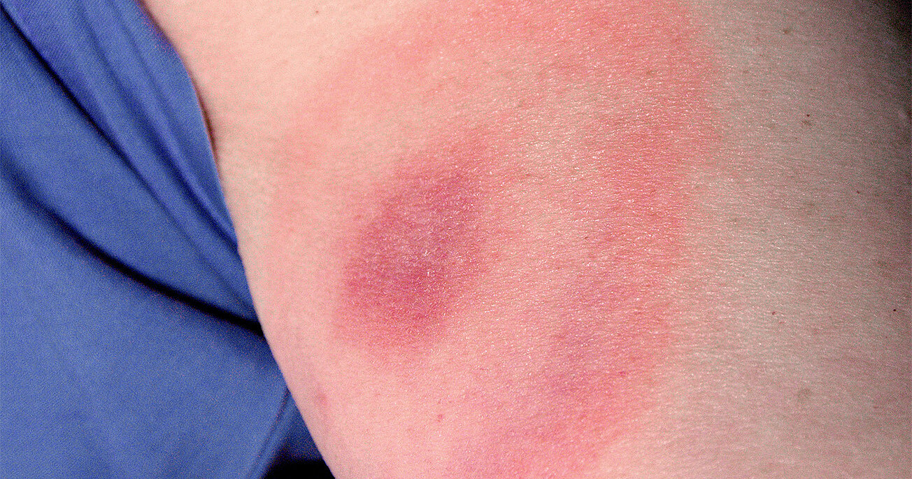 HZI | Lyme disease: Probability of developing the disease is ...